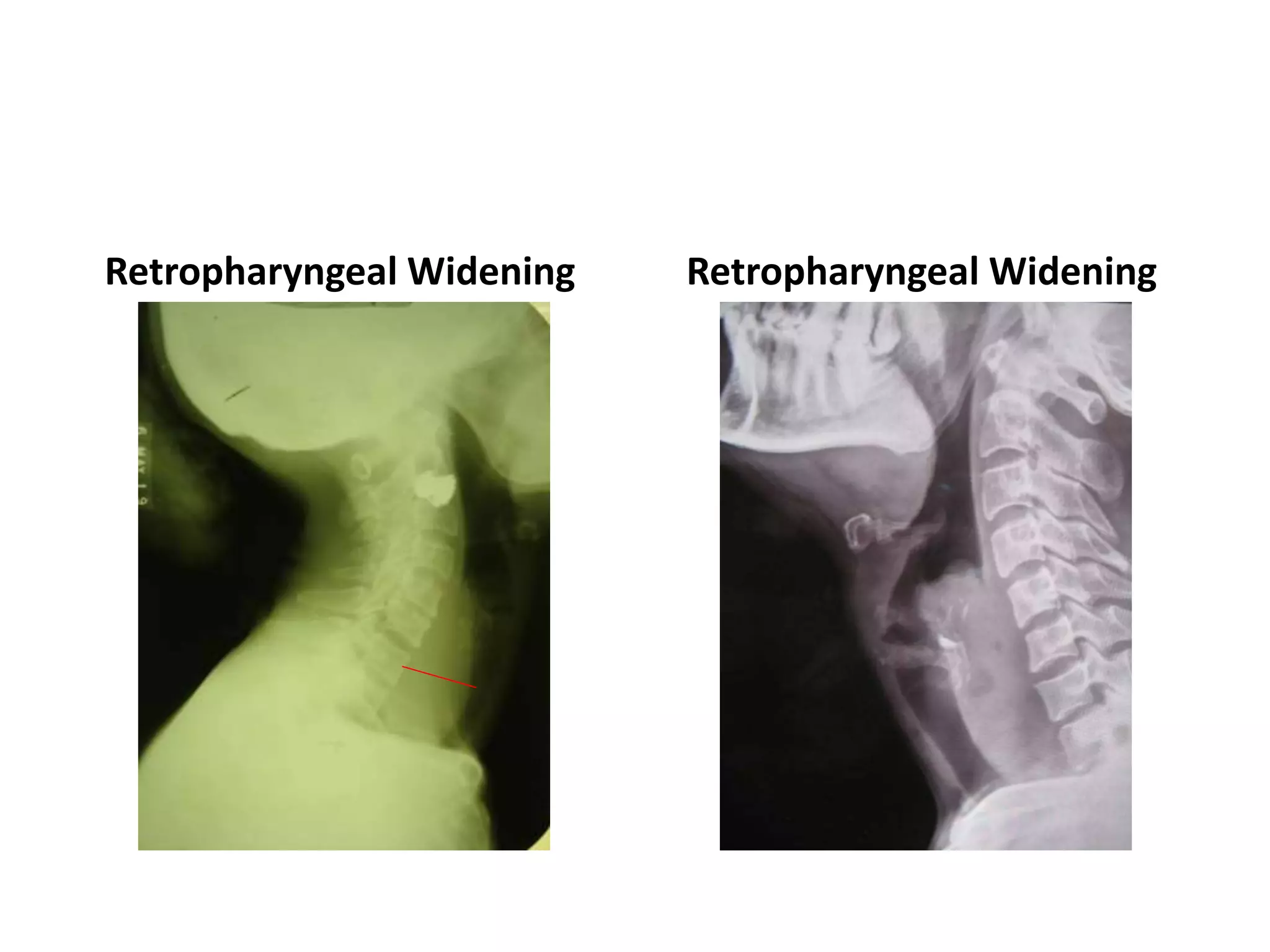 Anicipating Difficult endotracheal intubation-Xray Soft tissue neck A ...