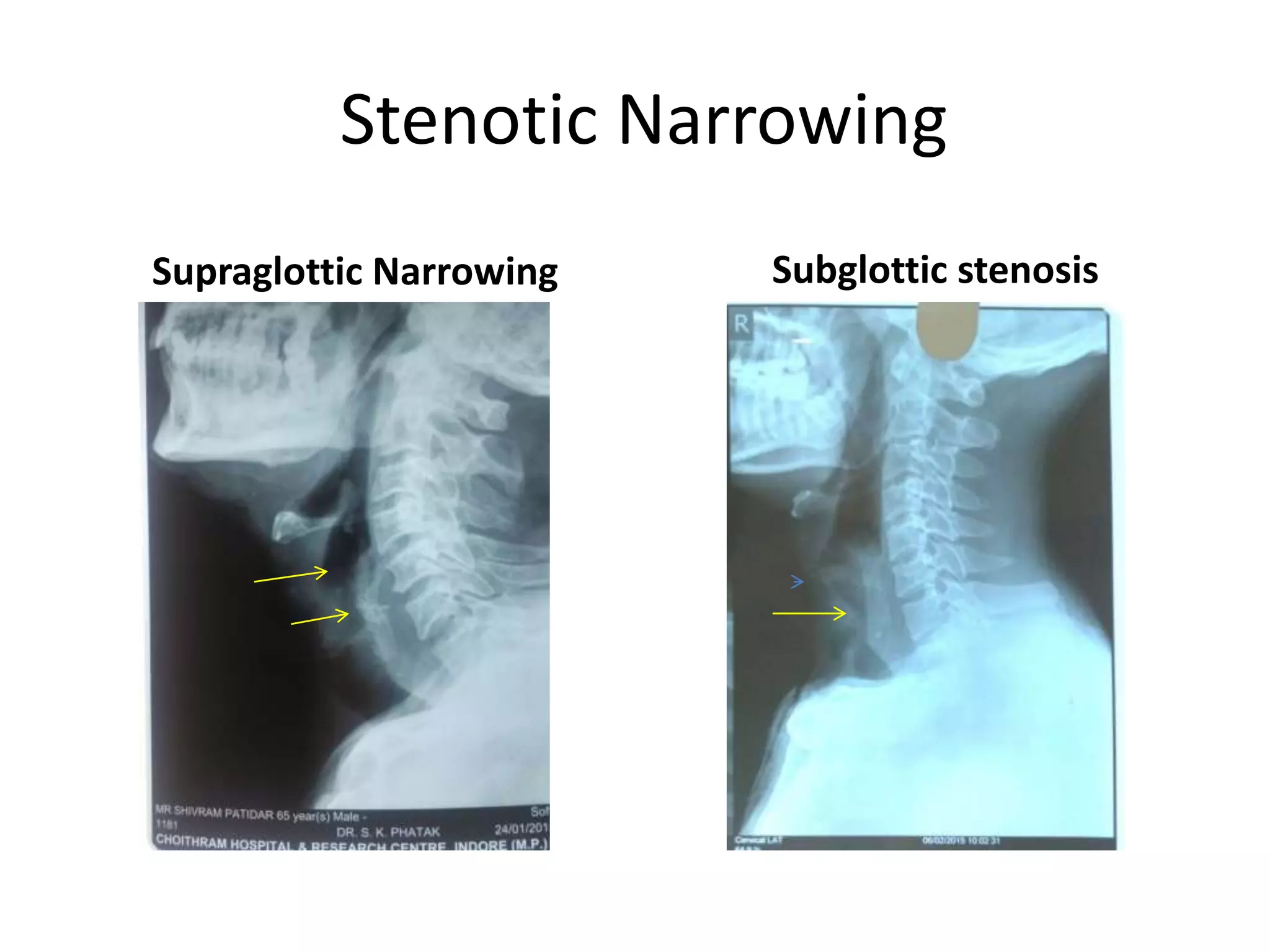 Anicipating Difficult endotracheal intubation-Xray Soft tissue neck A ...