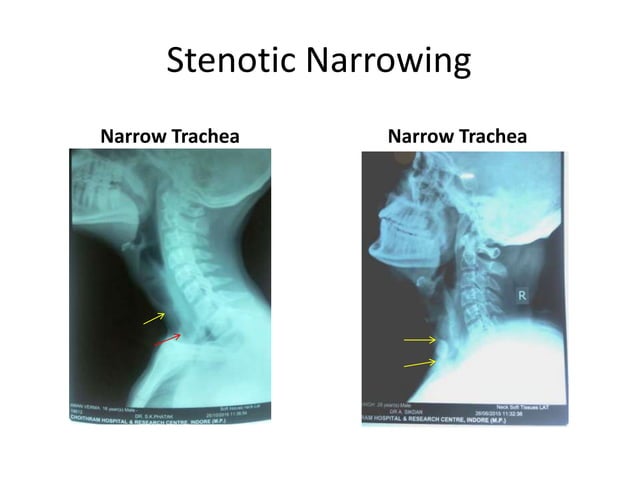 Anicipating Difficult endotracheal intubation-Xray Soft tissue neck A ...