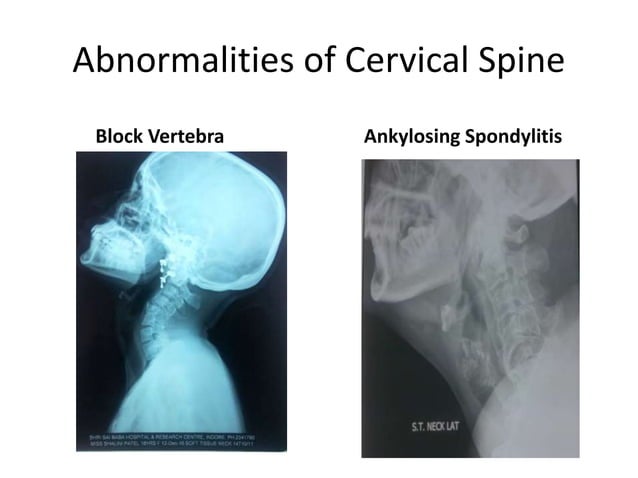 Anicipating Difficult endotracheal intubation-Xray Soft tissue neck A ...