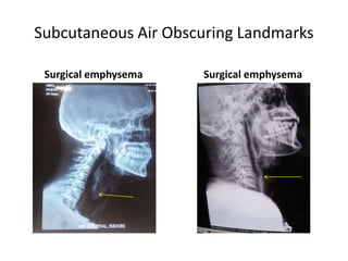 Anicipating Difficult endotracheal intubation-Xray Soft tissue neck A ...