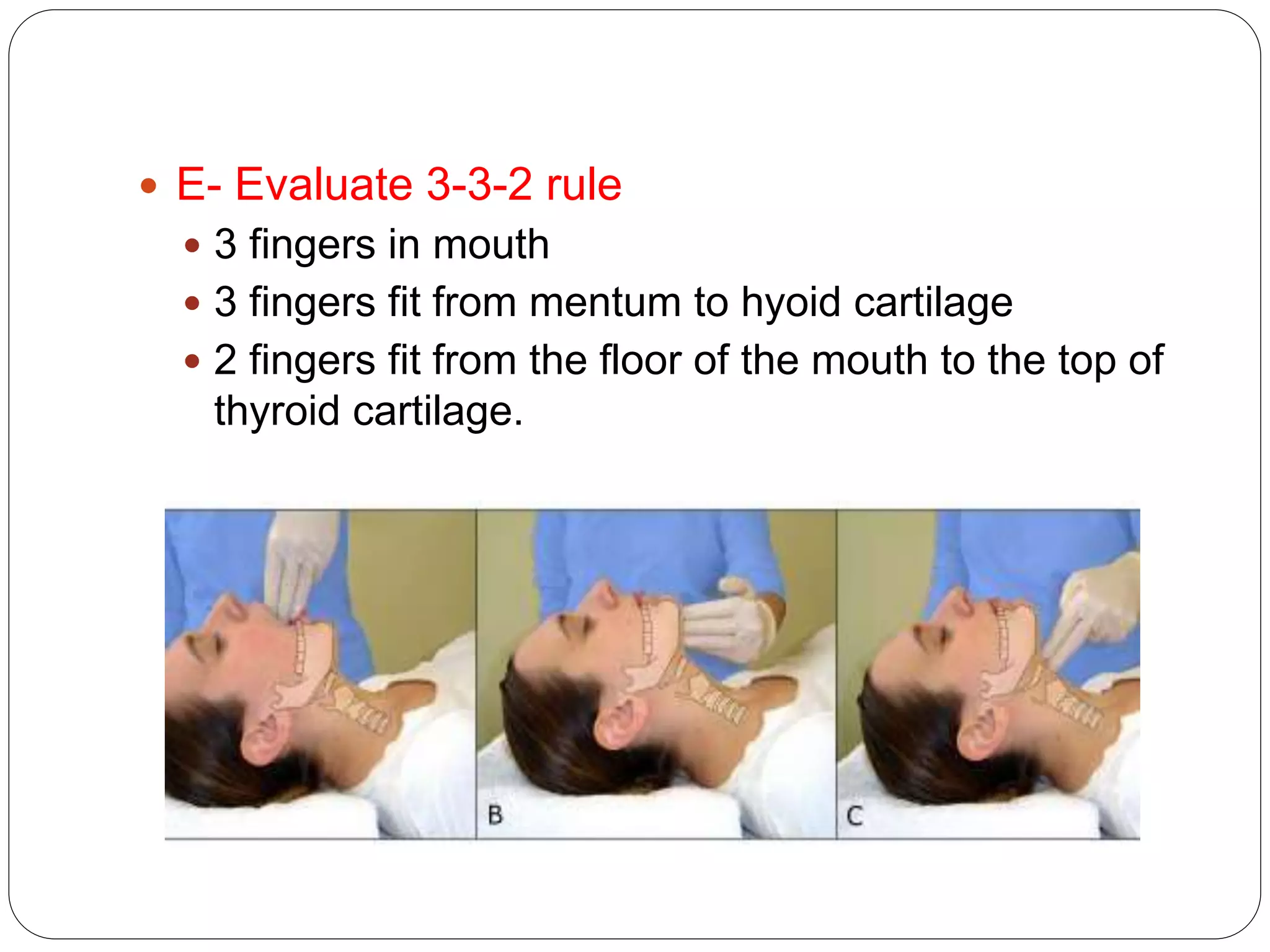 Difficult airway | PPTX
