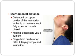 Sternomental Distance