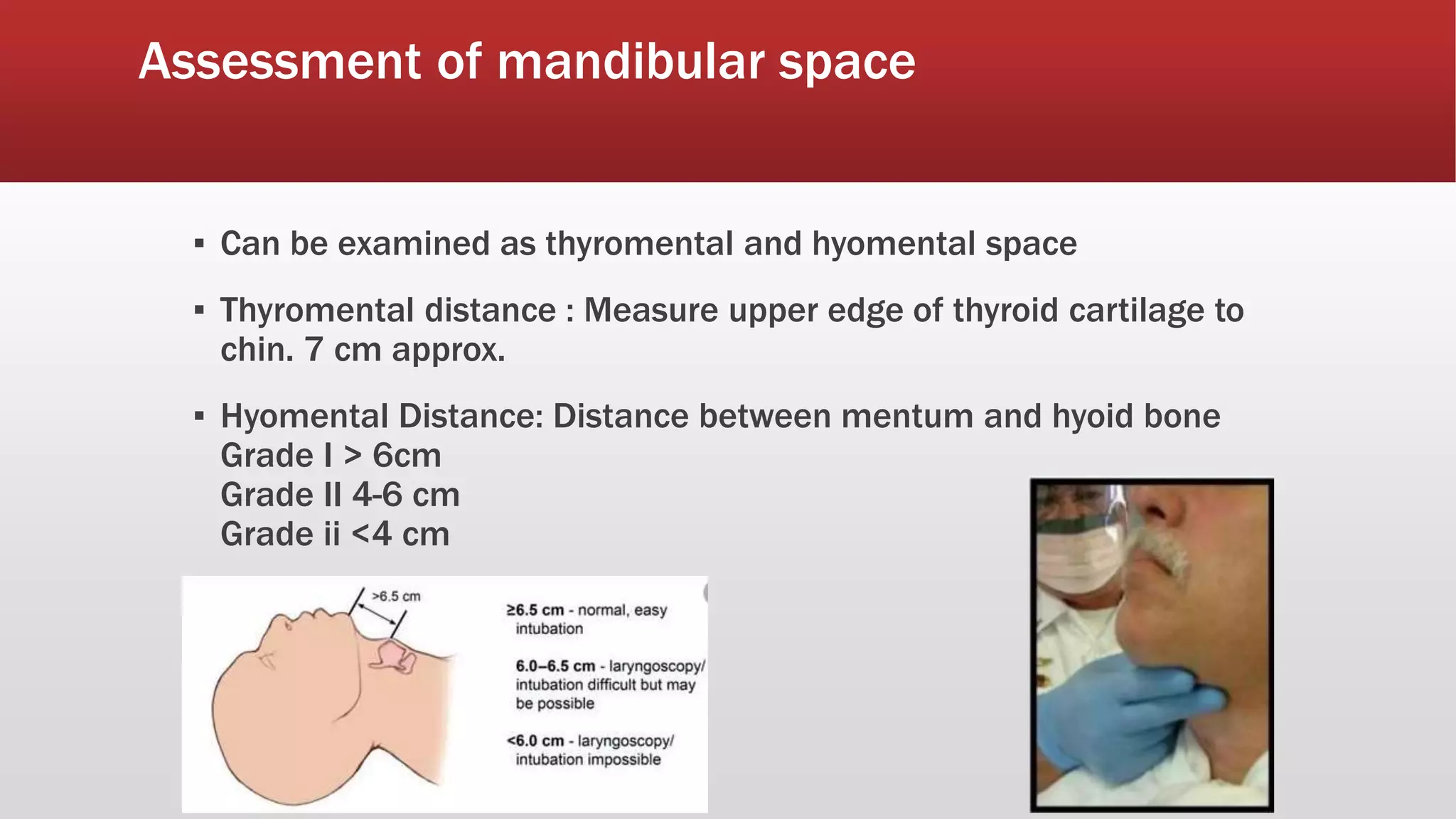Difficult airway assessment and management by sardar saud abbas | PPTX