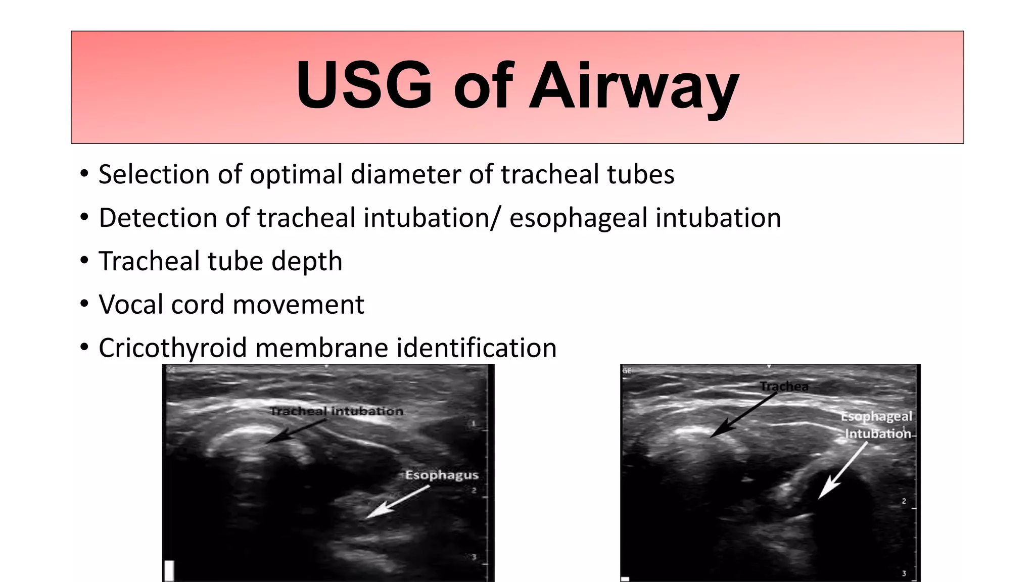 Difficult airway guidelines paeds | PPTX