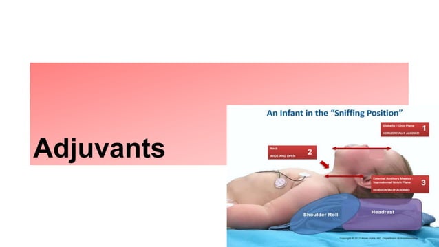 Difficult airway guidelines paeds | PPTX