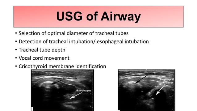 Difficult Airway Guidelines Paeds Pptx