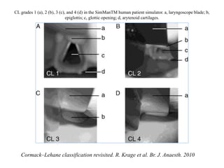Difficult airway in ICU by Dr. Aditya Jindal | JIndal Chest Clinic | PPTX
