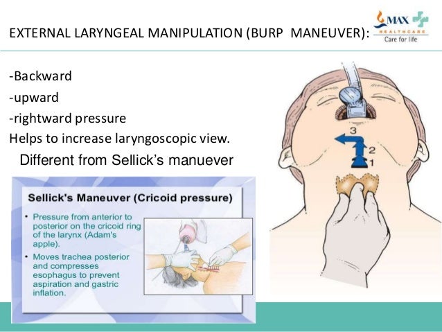 Difficult airway management in ICU