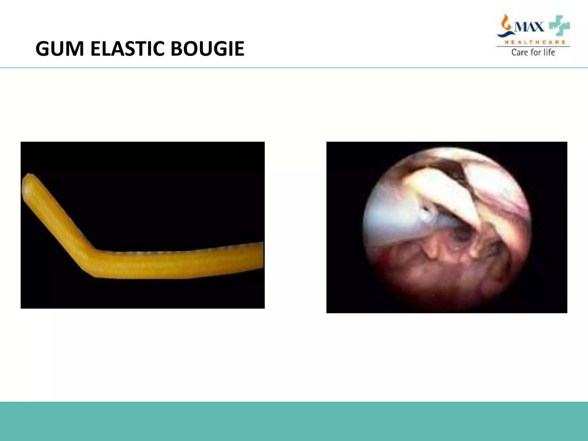 Difficult airway management | PPTX