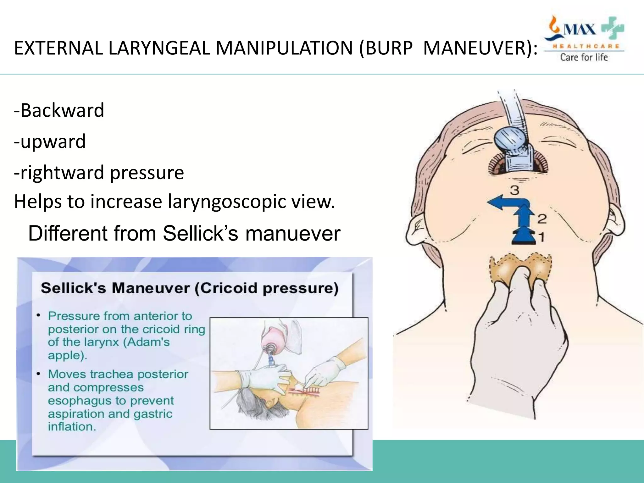Difficult airway management | PPTX