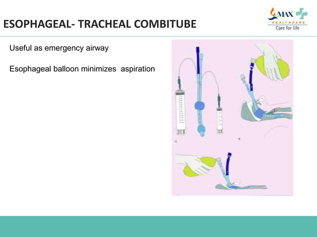 Difficult airway management | PPTX