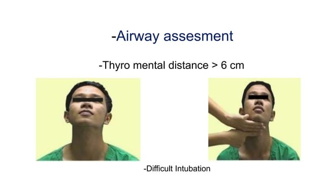 Difficult airway management | PPTX