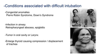 Difficult airway management | PPTX
