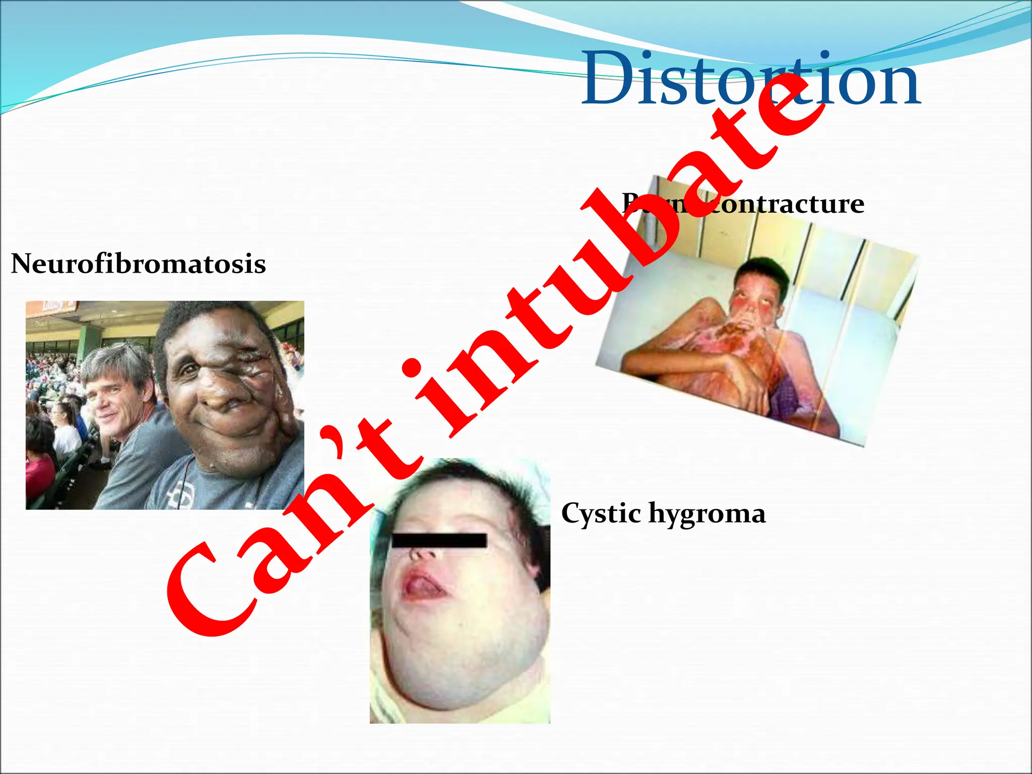 difficult airway managment indication and methed.ppt