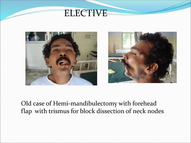 difficult airway managment indication and methed.ppt