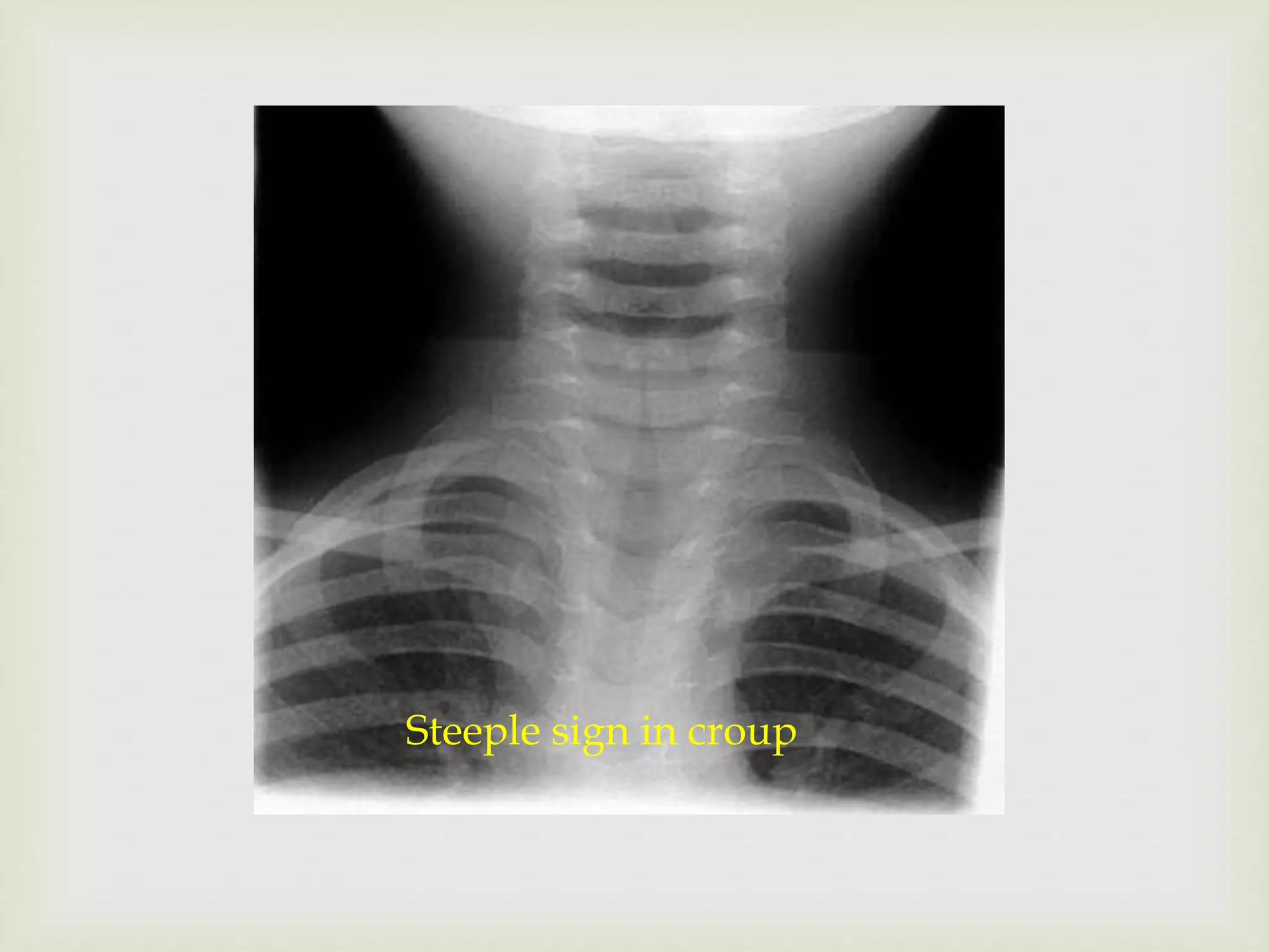 Difficult breathing in children | PPTX