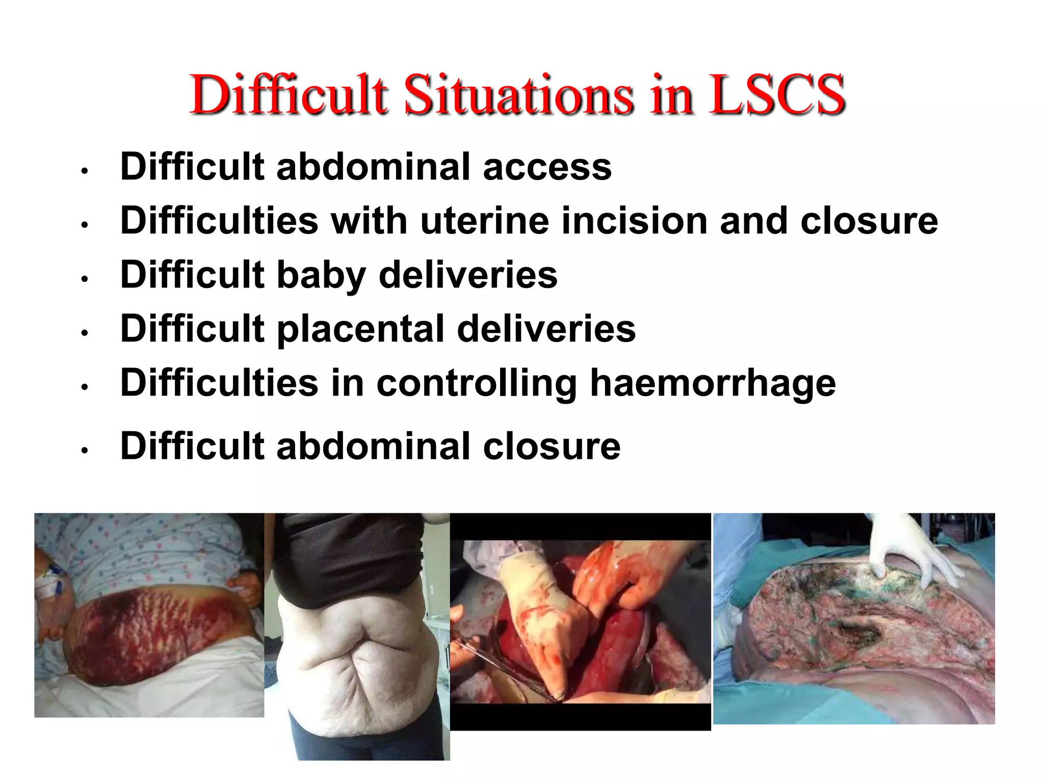 Difficult c section | PPTX
