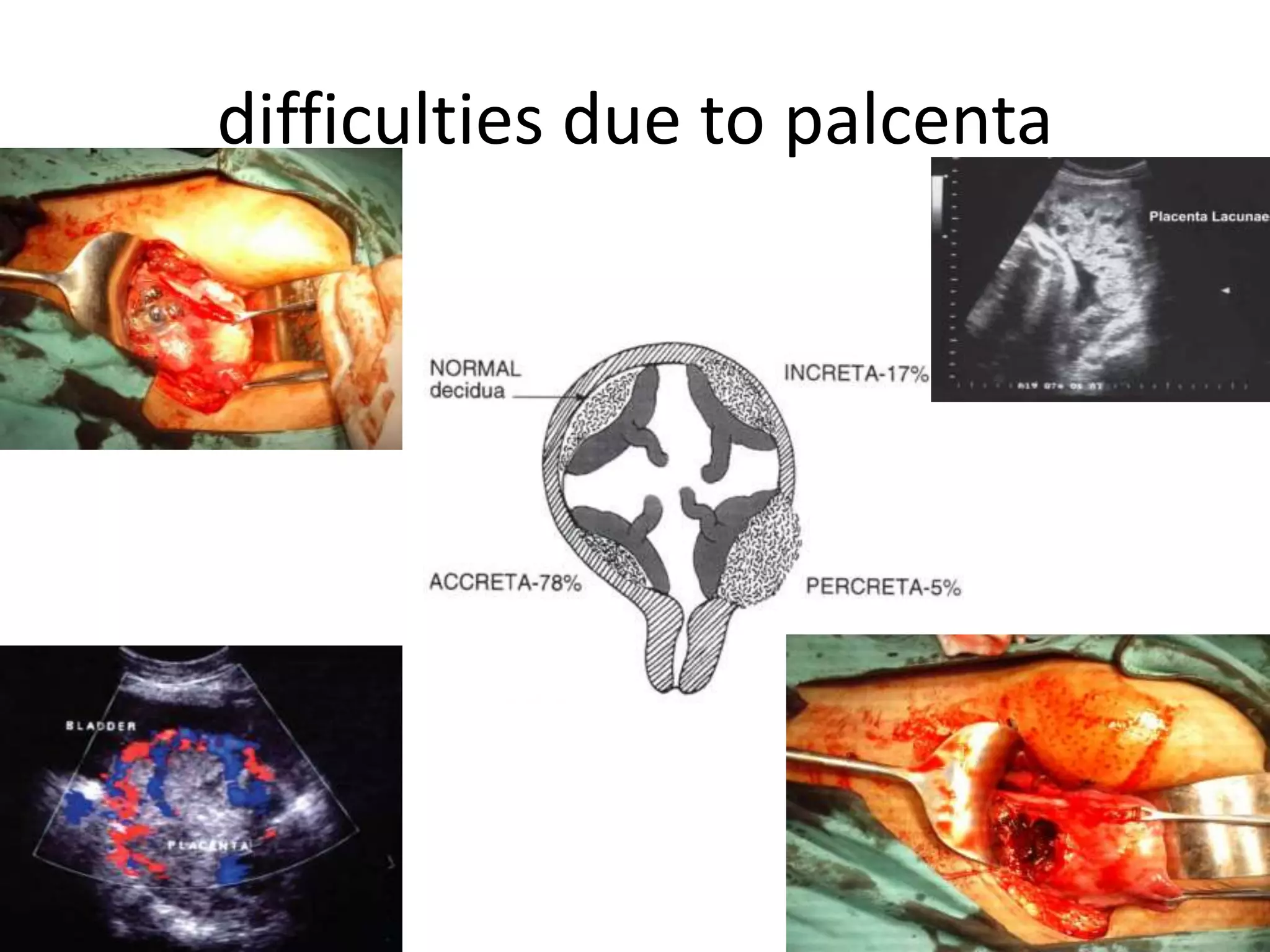 Difficult c section | PPTX