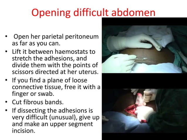 Difficult c section | PPTX