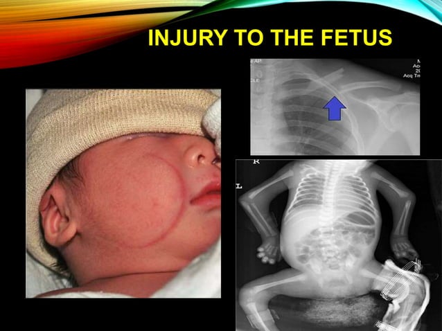 Difficult extraction of the fetus presented in aicog 09.01.19