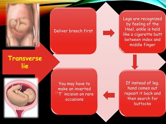 Difficult extraction of the fetus presented in aicog 09.01.19