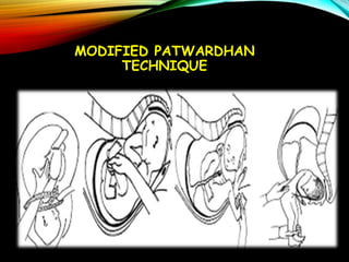 Difficult extraction of the fetus presented in aicog 09.01.19