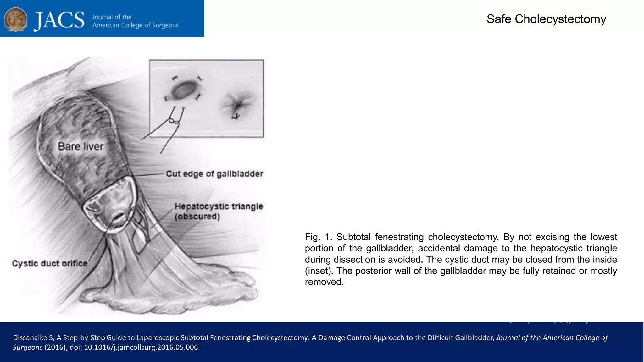 Difficult Gallbladder.pptx