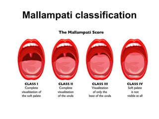 DIFFICULT__INTUBATION.pptx