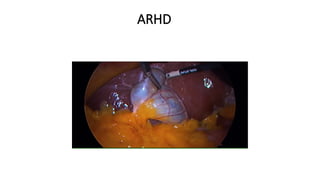 Difficult Laparoscopic cholecystectomy The Clinnic.pptx