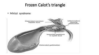 Difficult Laparoscopic cholecystectomy The Clinnic.pptx