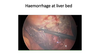 Difficult Laparoscopic cholecystectomy The Clinnic.pptx