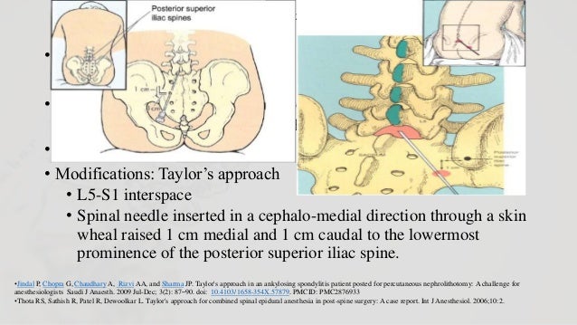 Difficult spine:my views!