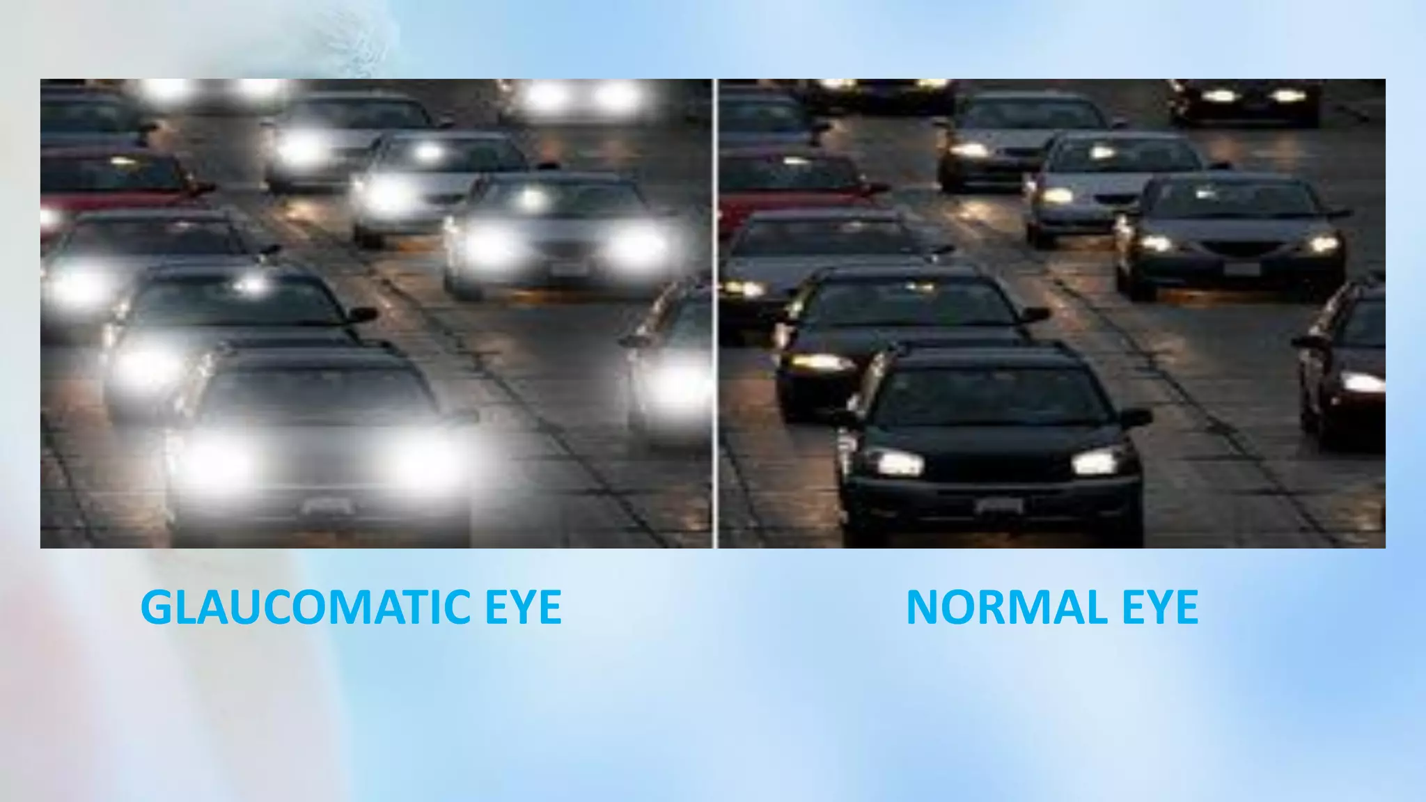 Diffraction in glaucomatic eye | PDF