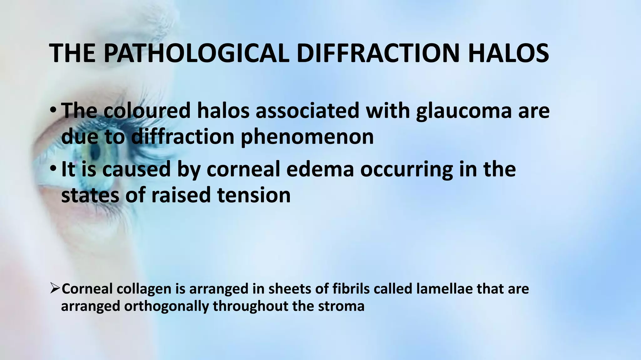 Diffraction in glaucomatic eye | PDF