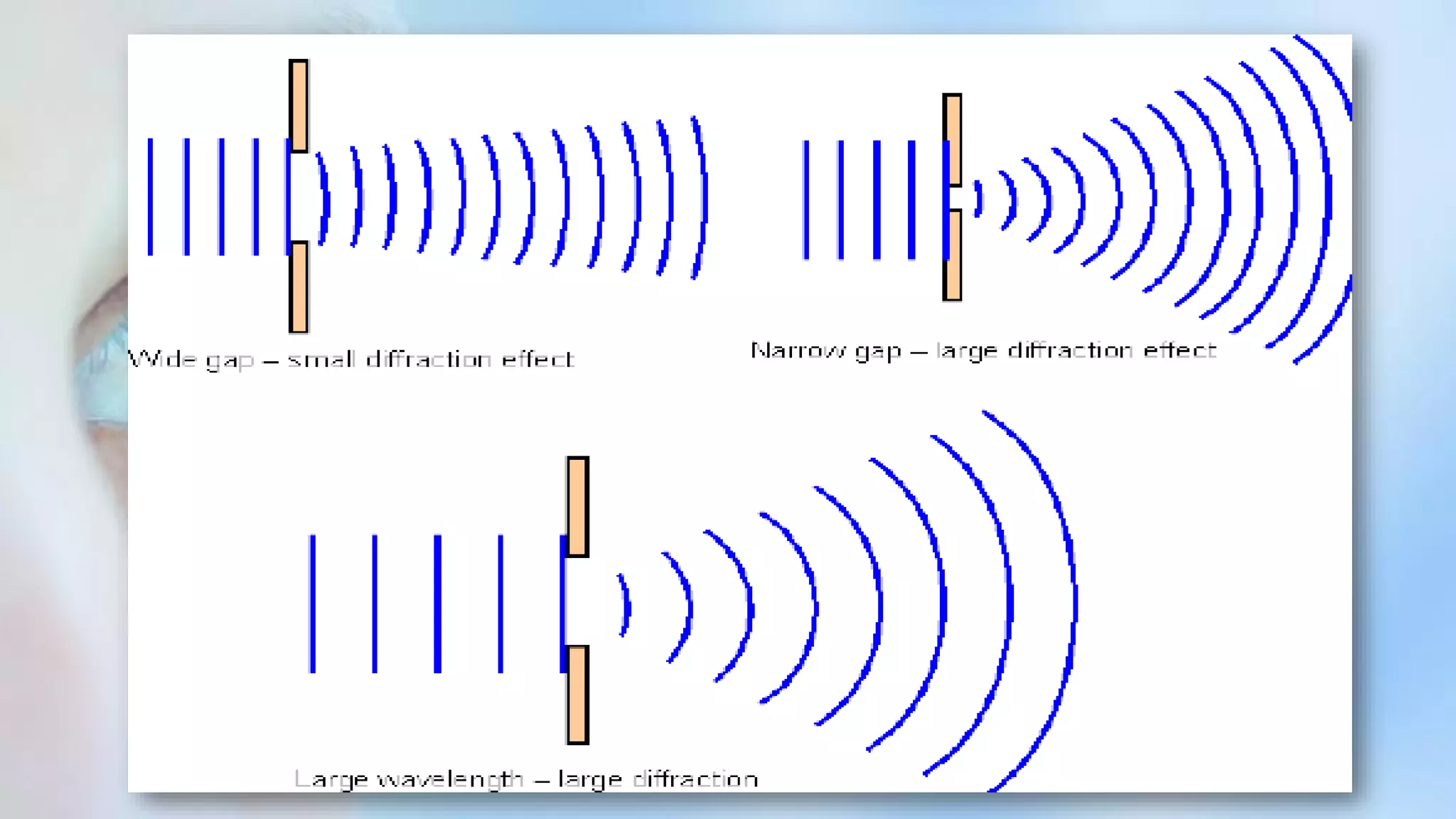 Diffraction in glaucomatic eye | PDF
