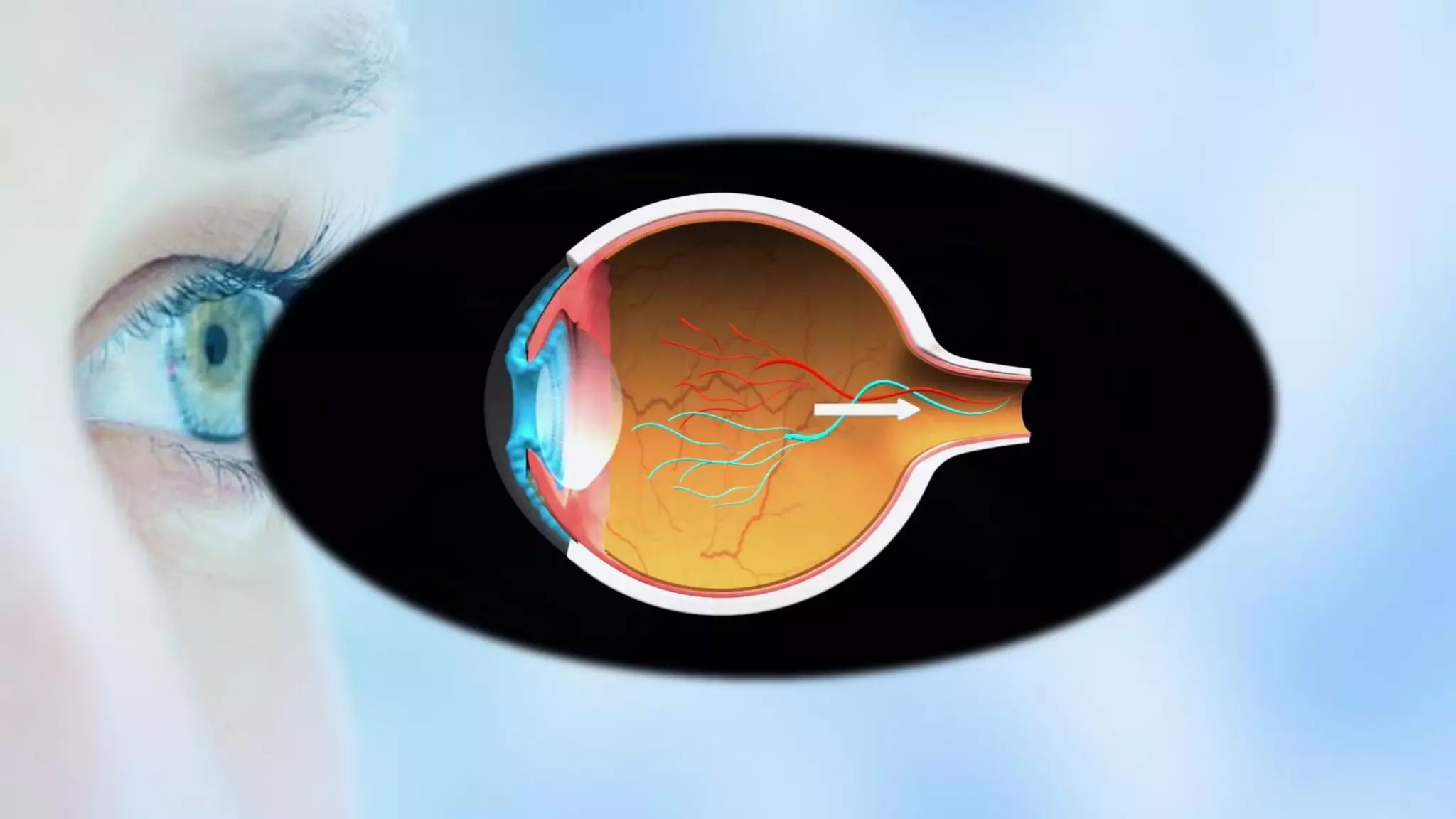 Diffraction in glaucomatic eye | PDF