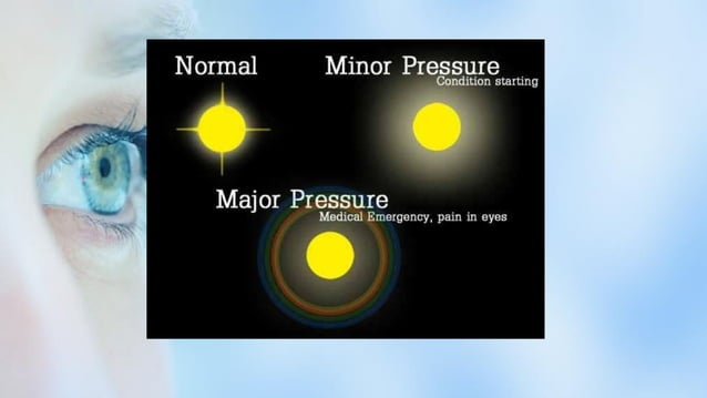 Diffraction in glaucomatic eye | PPT