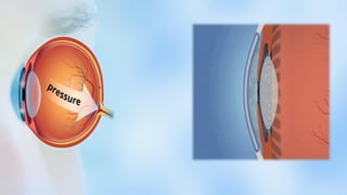 Diffraction in glaucomatic eye | PPT