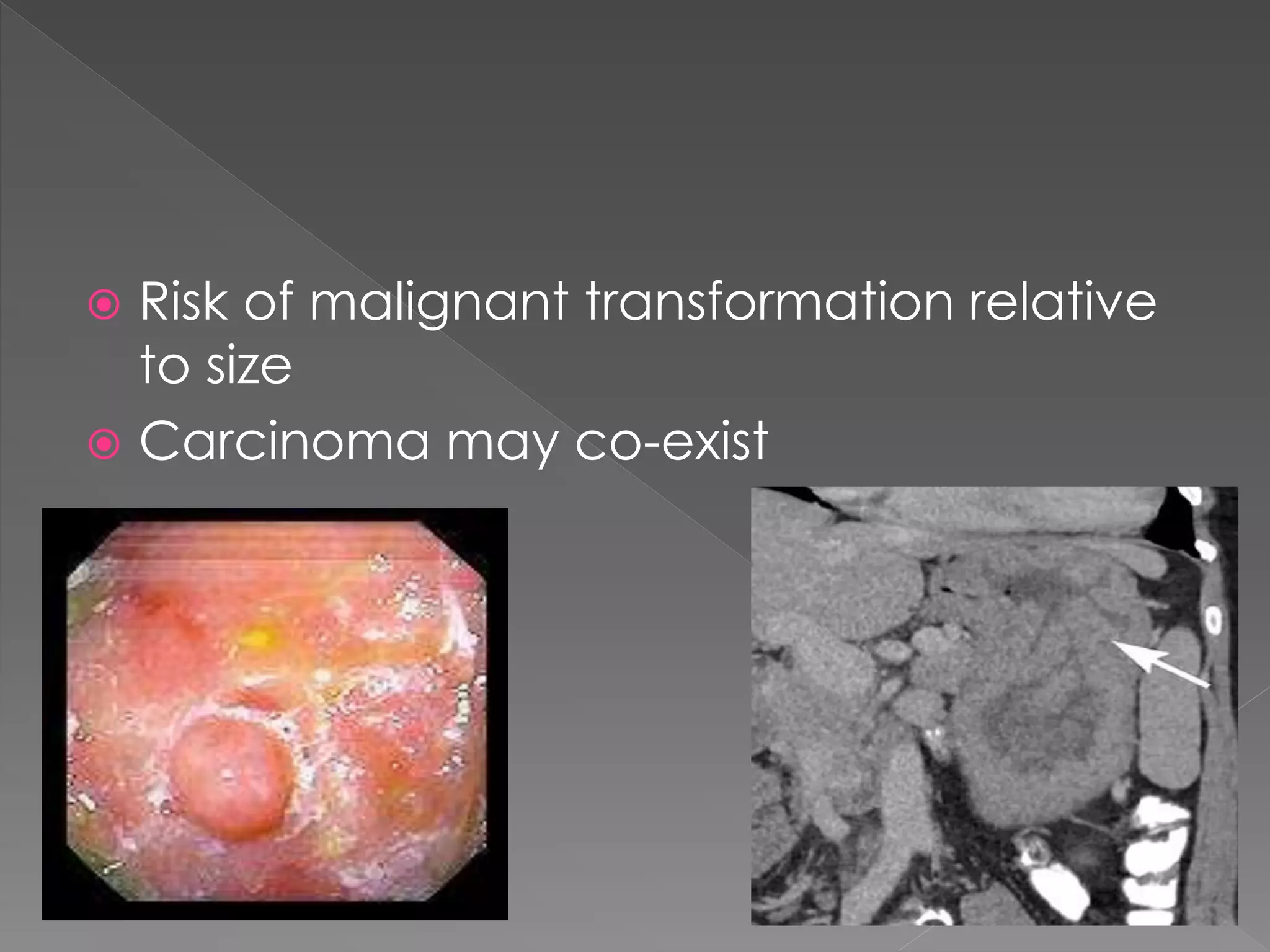 Diffrential diagnosis of gastric masses and narrowing | PPTX ...