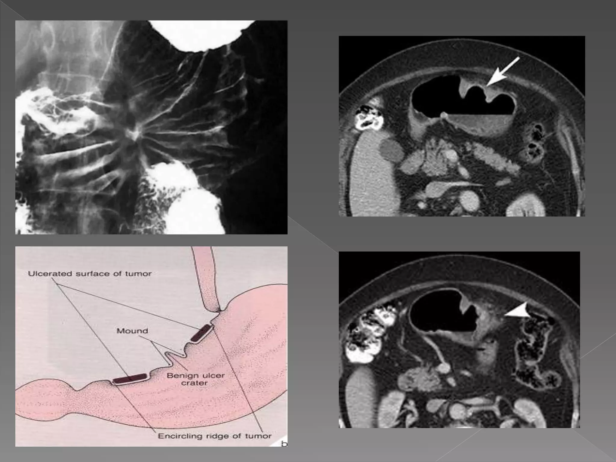 Diffrential diagnosis of gastric masses and narrowing | PPTX ...