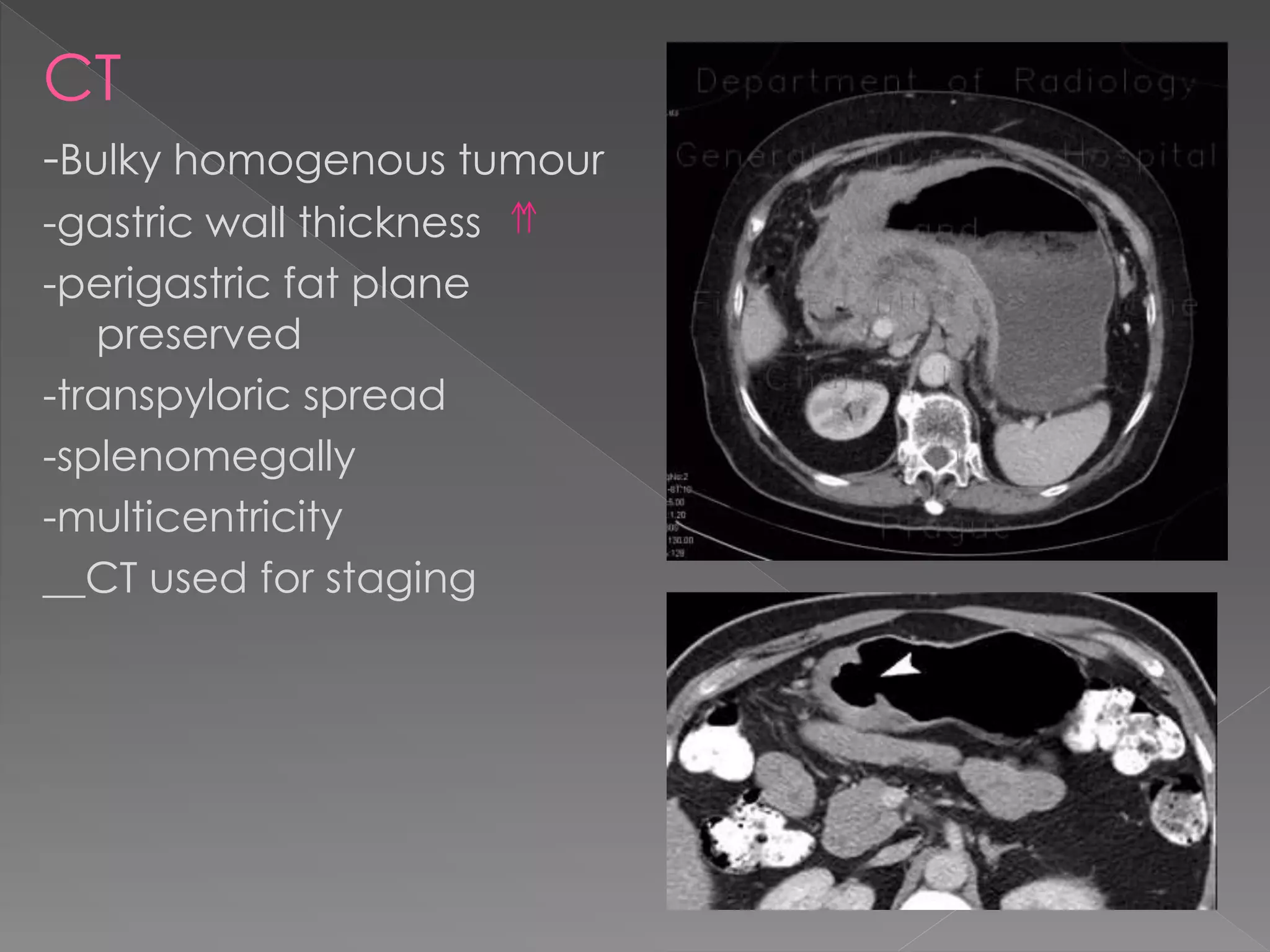 Diffrential diagnosis of gastric masses and narrowing | PPTX ...