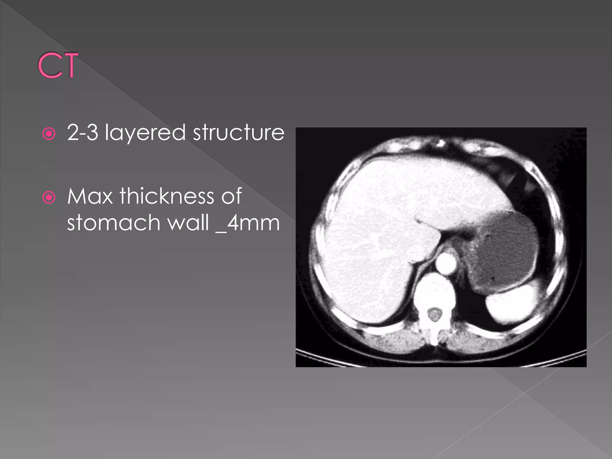 Diffrential diagnosis of gastric masses and narrowing | PPTX ...