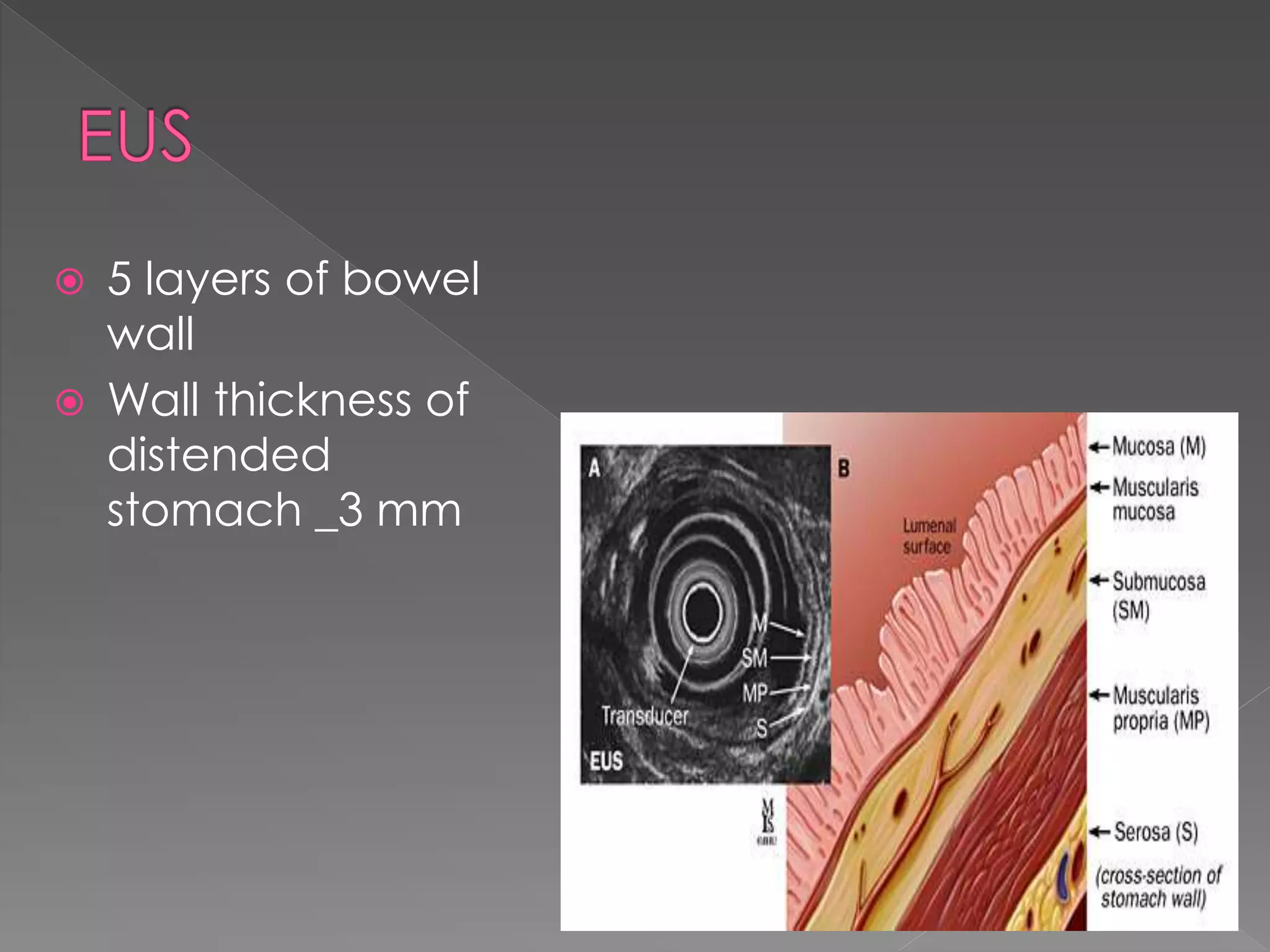 Diffrential diagnosis of gastric masses and narrowing | PPTX ...