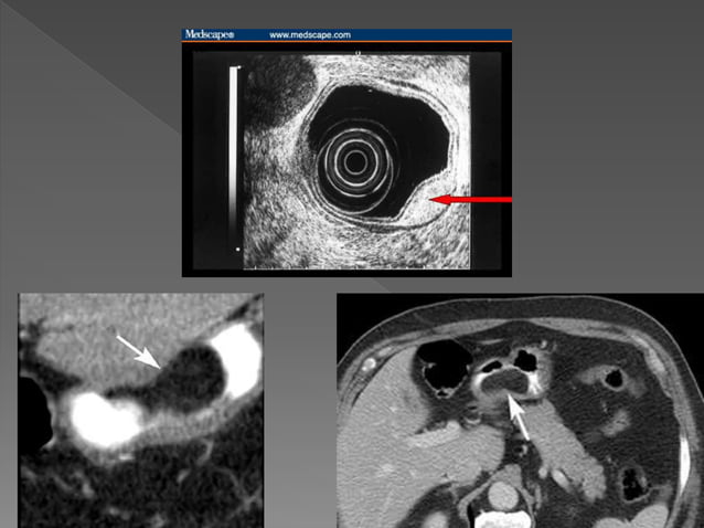 Diffrential diagnosis of gastric masses and narrowing | PPTX ...