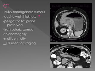 Diffrential diagnosis of gastric masses and narrowing | PPTX