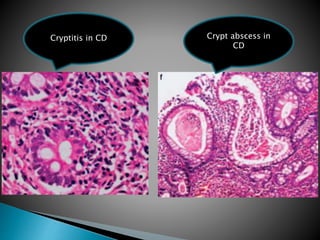Intestinal tuberculosis & crohn's disease | PPTX