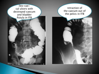 Intestinal tuberculosis & crohn's disease | PPTX