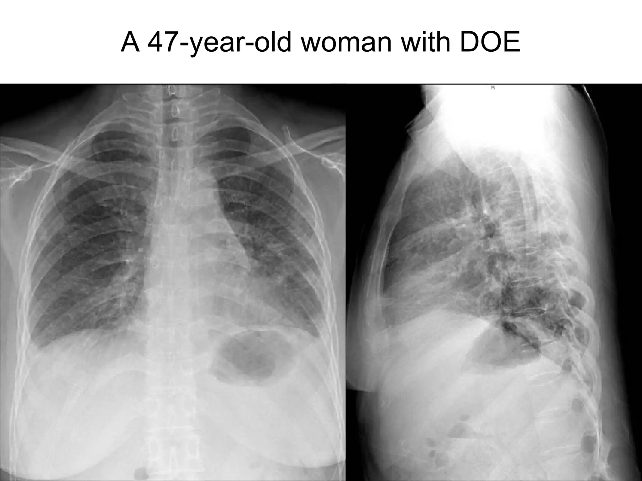 Diffuse alveolar damage | PPS
