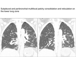 Diffuse alveolar damage | PPT